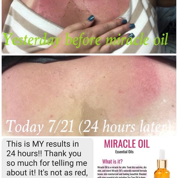 Pure Romance | Other | Miracle Oil By Pure Romance | Poshmark